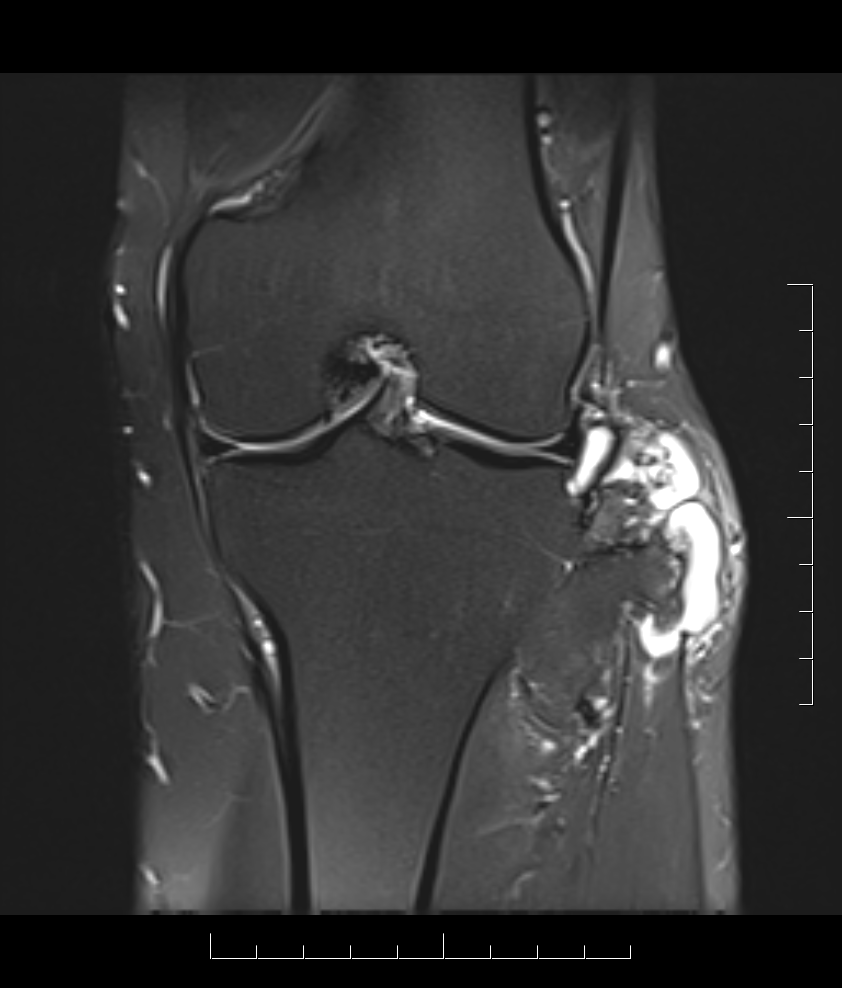 Chondrosarcoma Mri